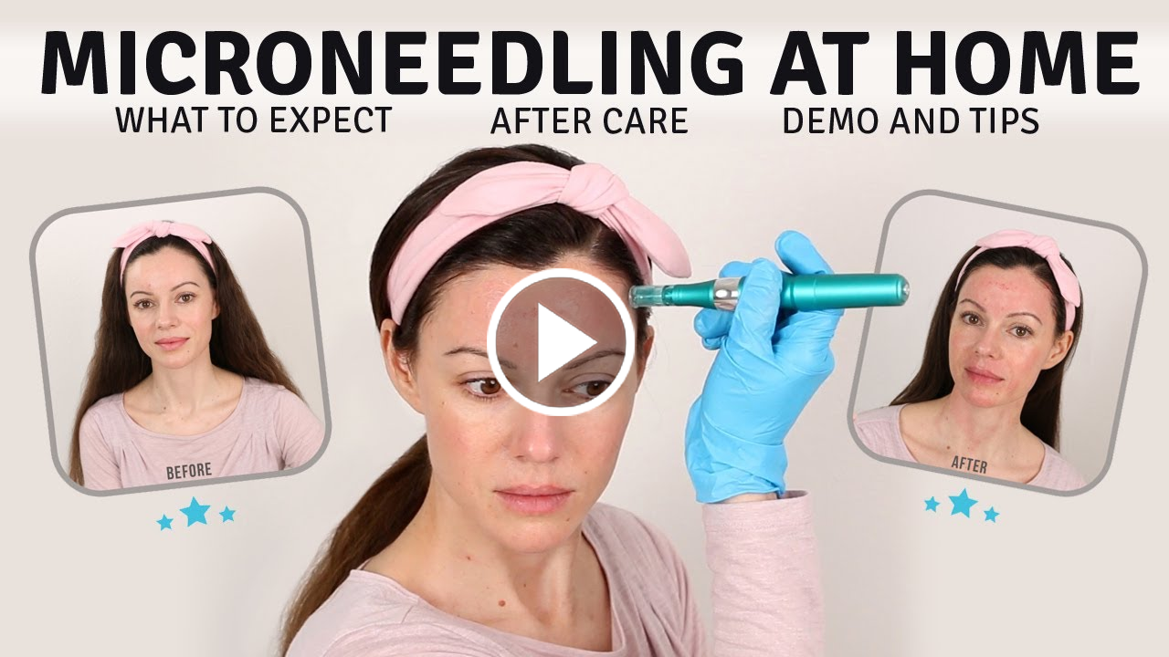 How I Microneedle at Home | Entire Process & Documentation Day by Day ...