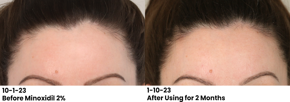 Minoxidil Before and Afters: Hairline Growth in Only 2 Months » Check ...