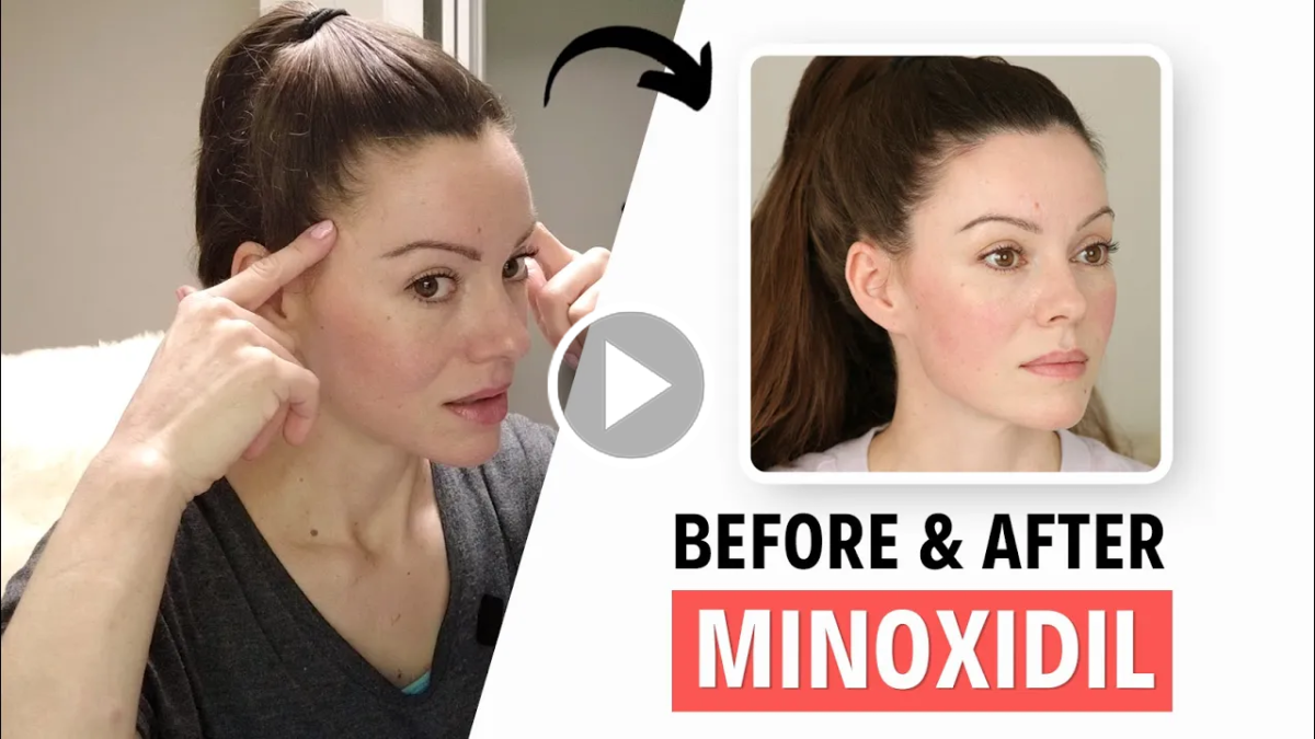 Minoxidil Before and Afters: Hairline Growth in Only 2 Months – Life ...